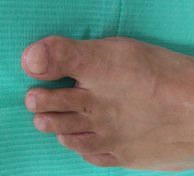 Reconstrucción Ungueal - SILVIA CABEZAS PODOLOGIA